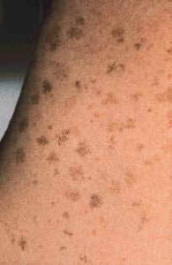 Melanocytic Nevi - Solar Lentigo | Perri Dermatology