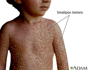 Graphic of Child with Smallpox | Perri Dermatology