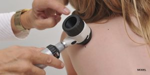 Melanocytic Nevi - Recurrent Nevus | Perri Dermatology